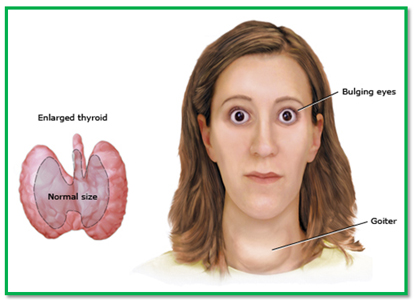 Hyperthyroidism treatment at Philadelphia Homeopathic Clinic