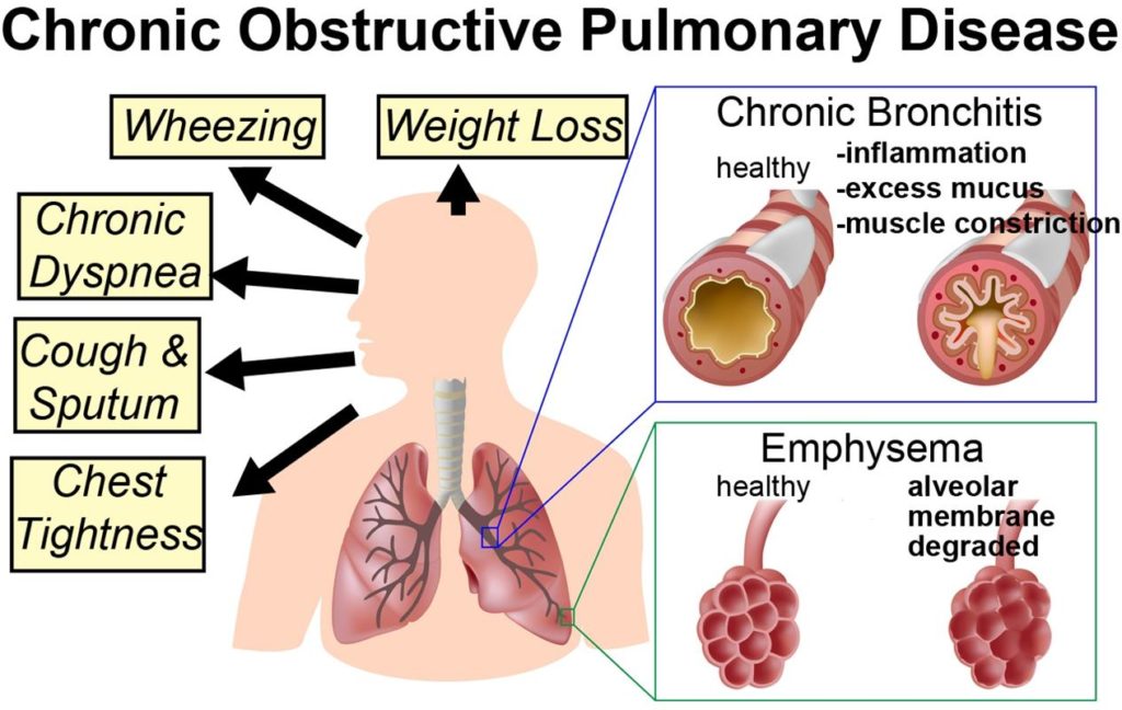 Treatment for COPD - Philadelphia Homeopathic Clinic - Dr. Tsan & Team