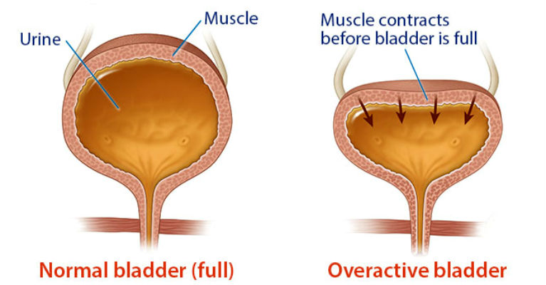 Overactive Bladder: Dr. Victor Tsan at the Philadelphia Homeopathic Clinic
