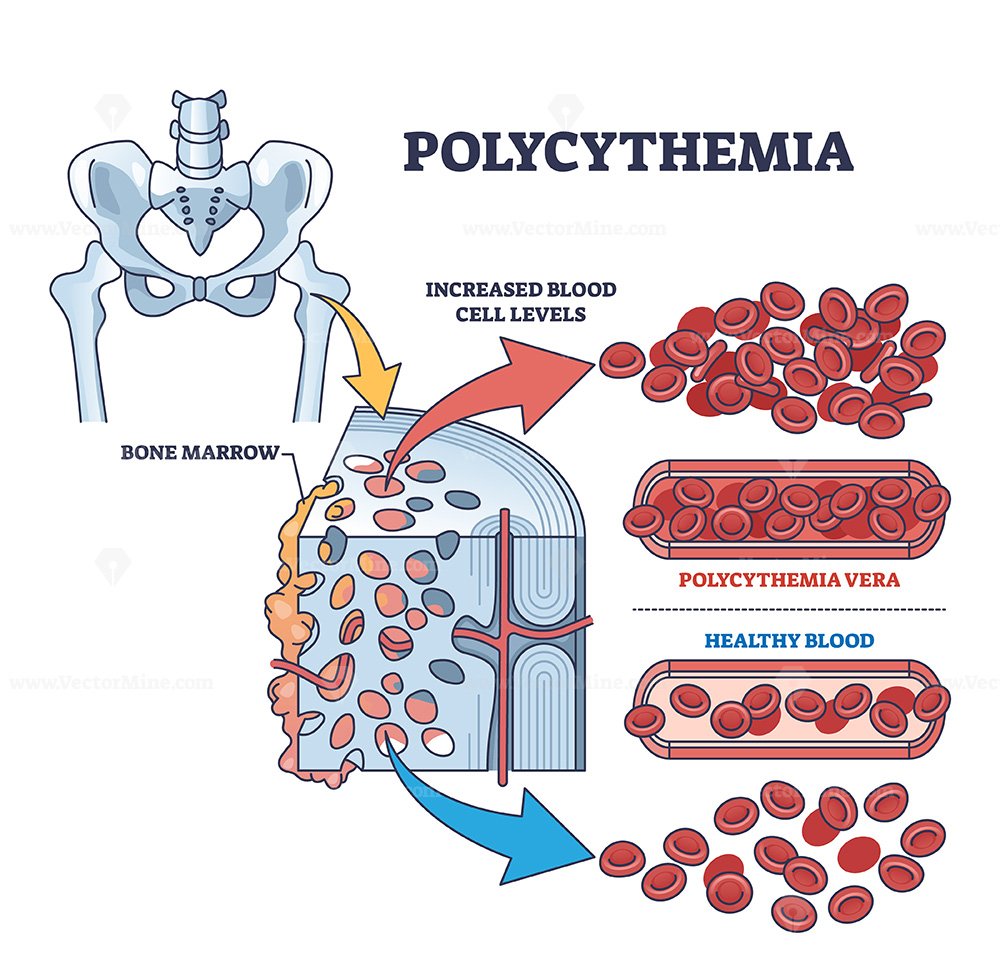 Polycythemia: Causes, Symptoms, and Holistic Treatment