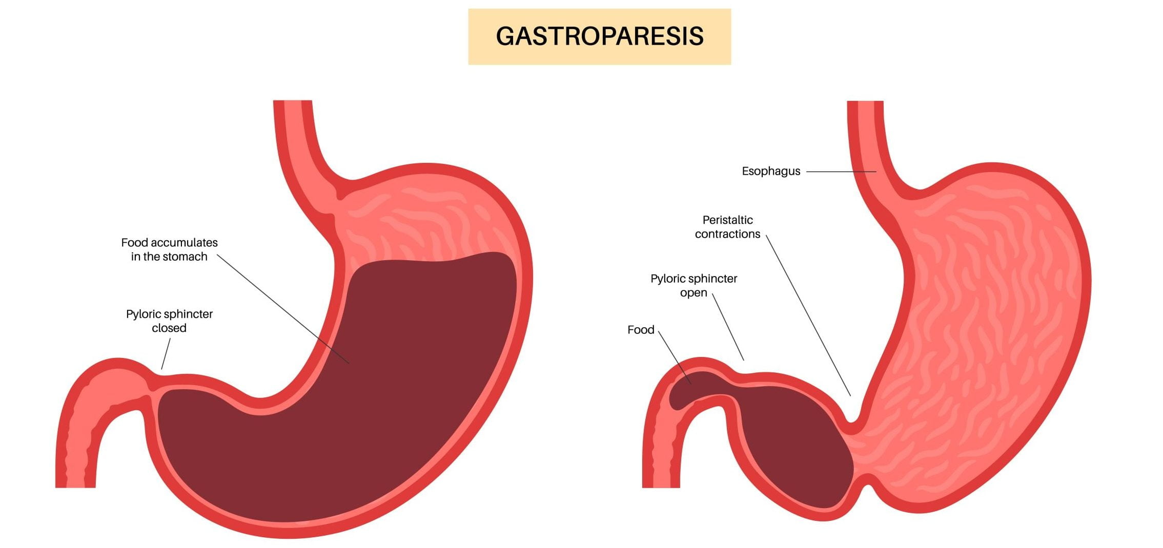 Gastroparesis: Causes, Symptoms, and Holistic Treatments - Philadelphia ...