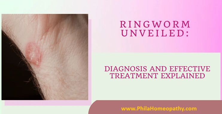 Ringworm Disease: Causes, Symptoms & Homeopathic Treatment
