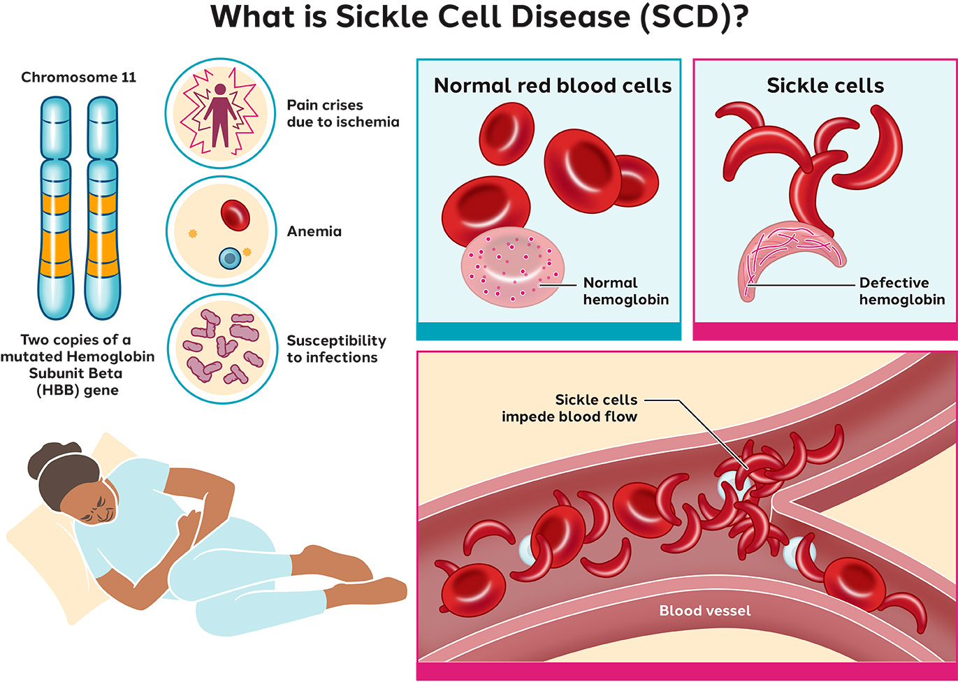 Sickle Cell Anemia: Causes, Symptoms, Treatments Approaches